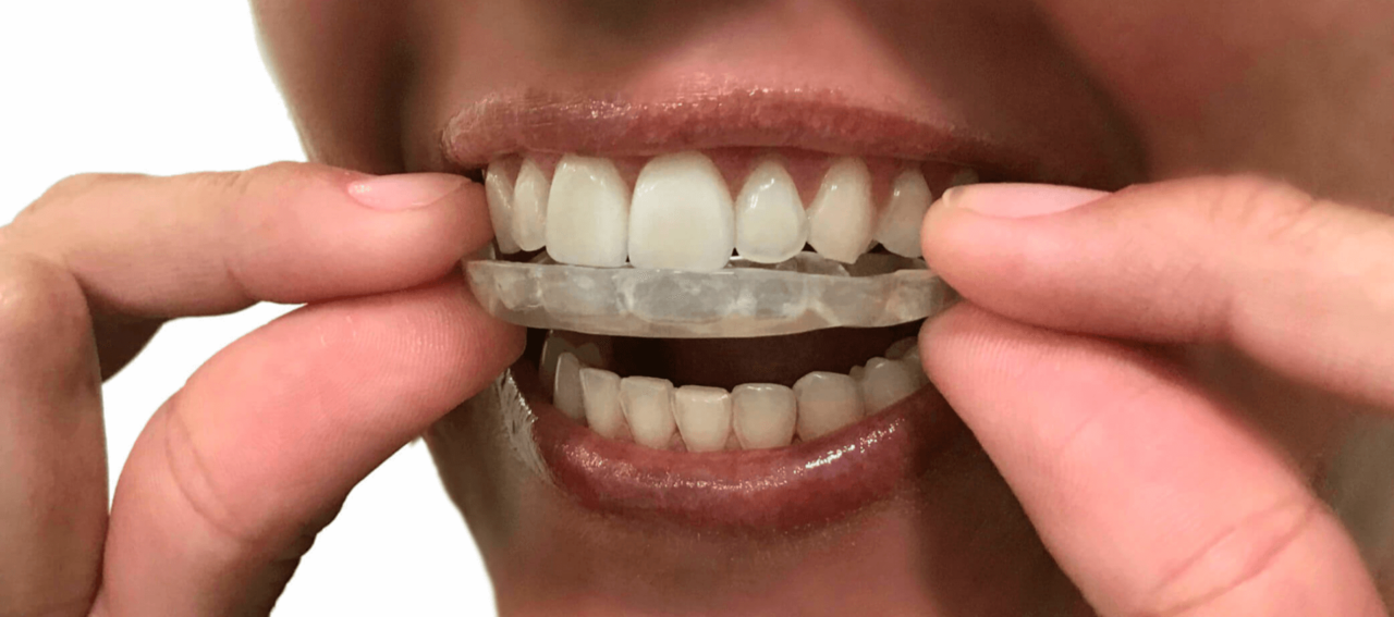 Cómo limpiar férula dental: Guía para blanquear y desinfectar