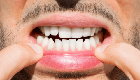 Tengo los colmillos montados: ¿qué puedo hacer para bajarlos y ...