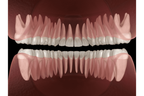 Torus mandibular: qué es y cuál es su tratamiento - P&P